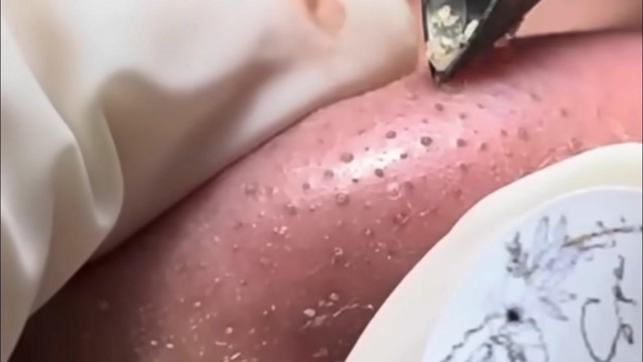 角栓抜き5 blackheads removal cabut comedo - YouTube