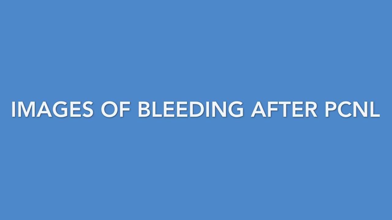 Images of Bleeding After PCNL - YouTube