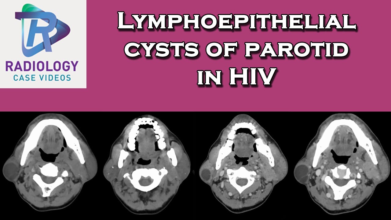 Lymphoepithelial cysts of parotid in HIV - YouTube