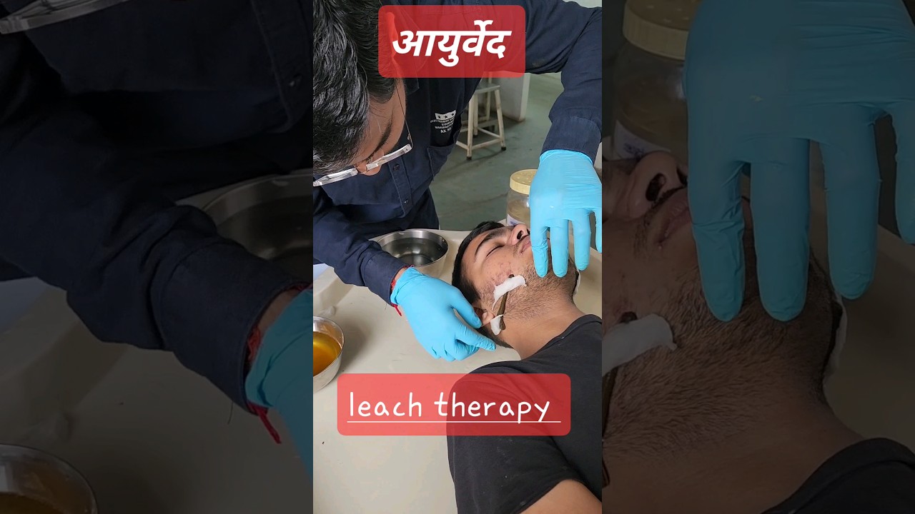 LEACH therapy in ayurveda|leeches on skin|#ayurveda #shorts #therapy # ...
