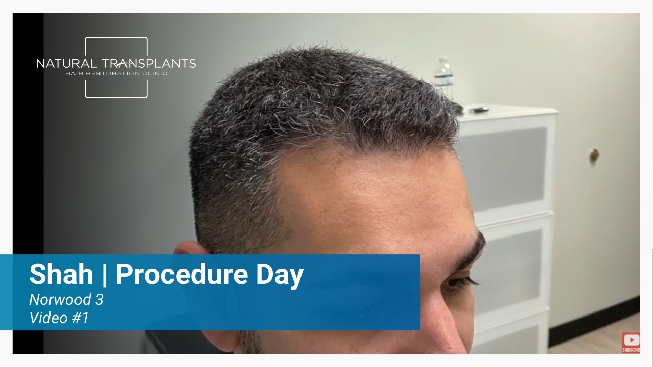 Asymmetrical Hairline Correction and Full Hairline Restoration | Dr ...