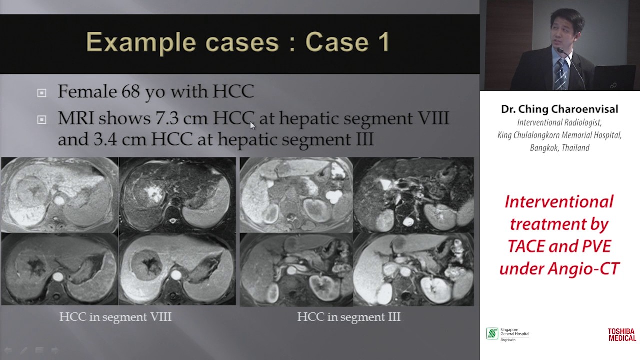 2 Interventional treatment by TACE and PVE under Angio CT - Dr Ching ...