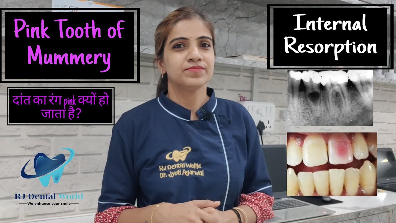Internal Resorption | Pink Tooth of Mummery | daant ka rang pink kyu ho ...