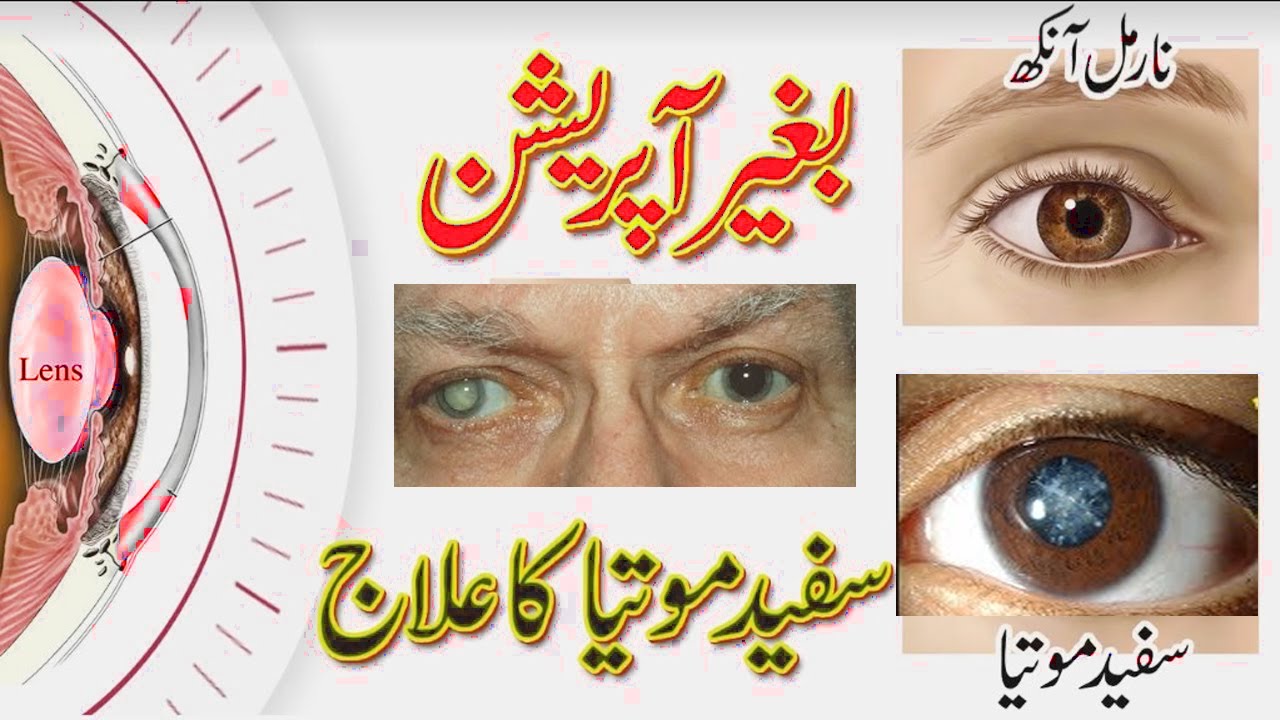 Bagair Operation Motiya (Cataract) ka ilaj - Safed Motia Ka ilaj ...