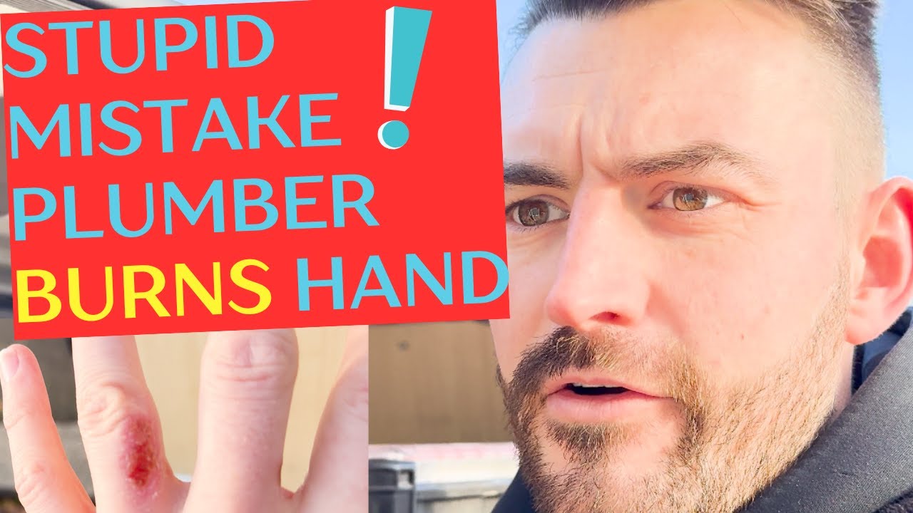 Back to Work After a Painful Burn – Loft First Fix Job Update ...