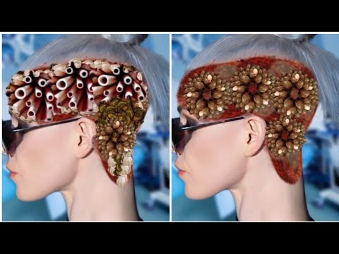 ASMR Remove Big Acne & Worm Infected Head Treatment || Deep Cleaning ...