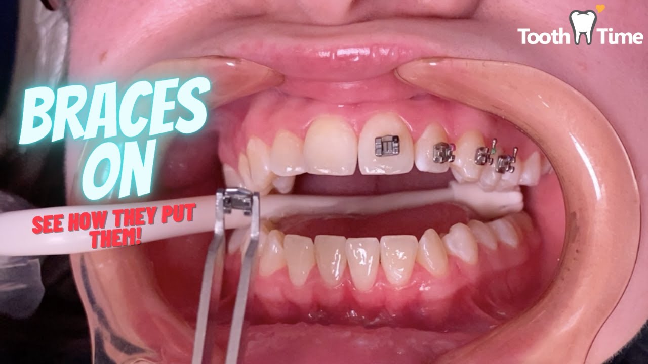 How Do They Put Braces On Tooth Time Family Dentistry New Braunfels YouTube how-do-they-put-braces-on-tooth-time-family-dentistry-new-braunfels-youtube