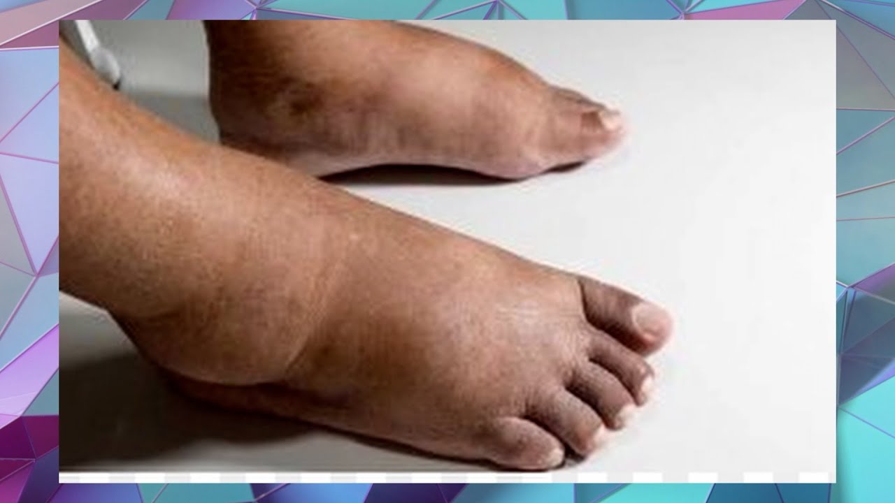 Conoce sobre el Pie de Charcot sus causas, síntomas y tratamiento - YouTube