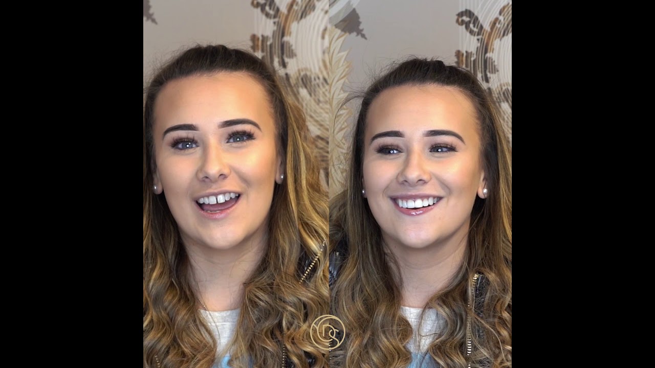 Chloe's Smile Makeover Before/After - YouTube