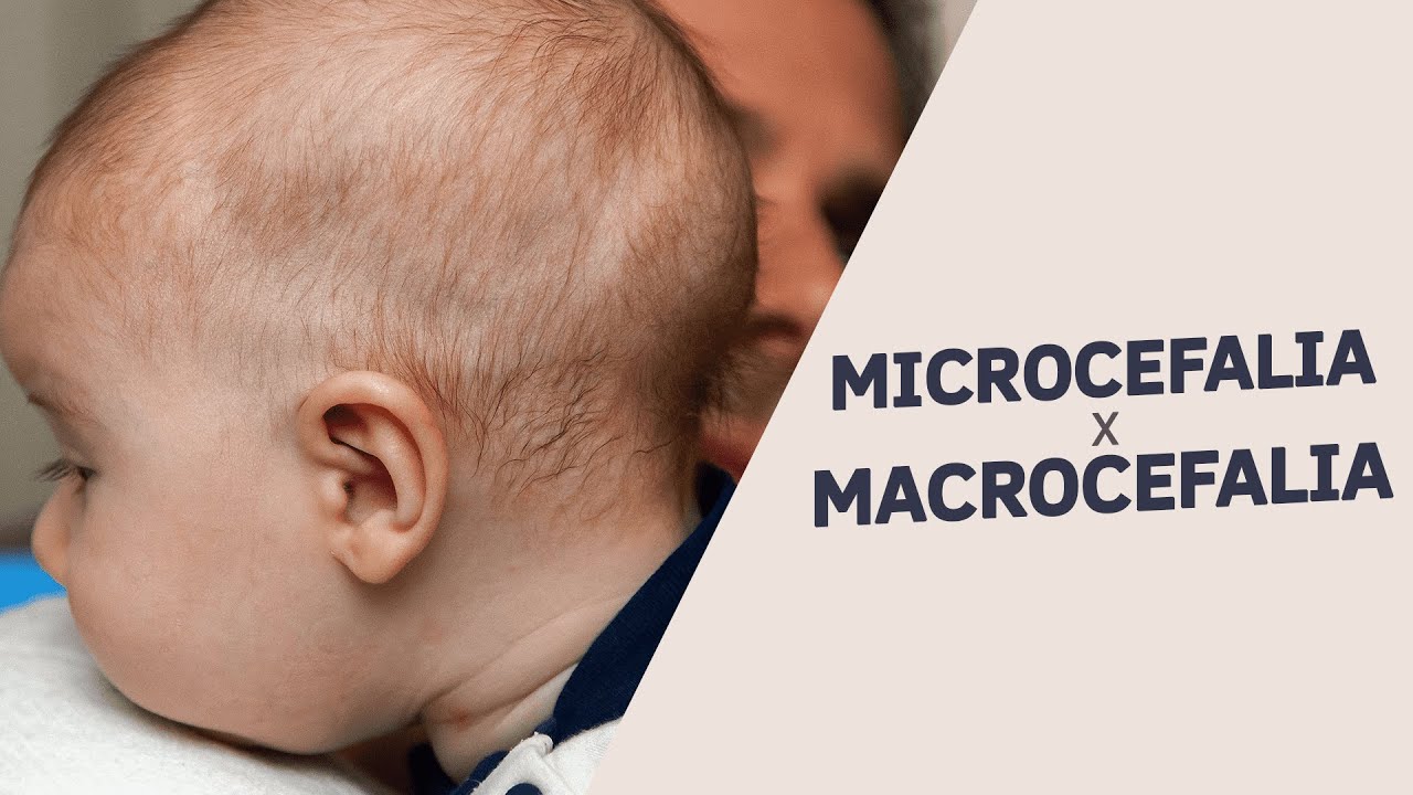 Microcefalia e Macrocefalia: Qual é a Diferença e Como identificar a ...