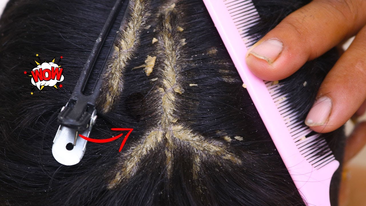 Scratching Dandruff Off Scalp 11 Youtube