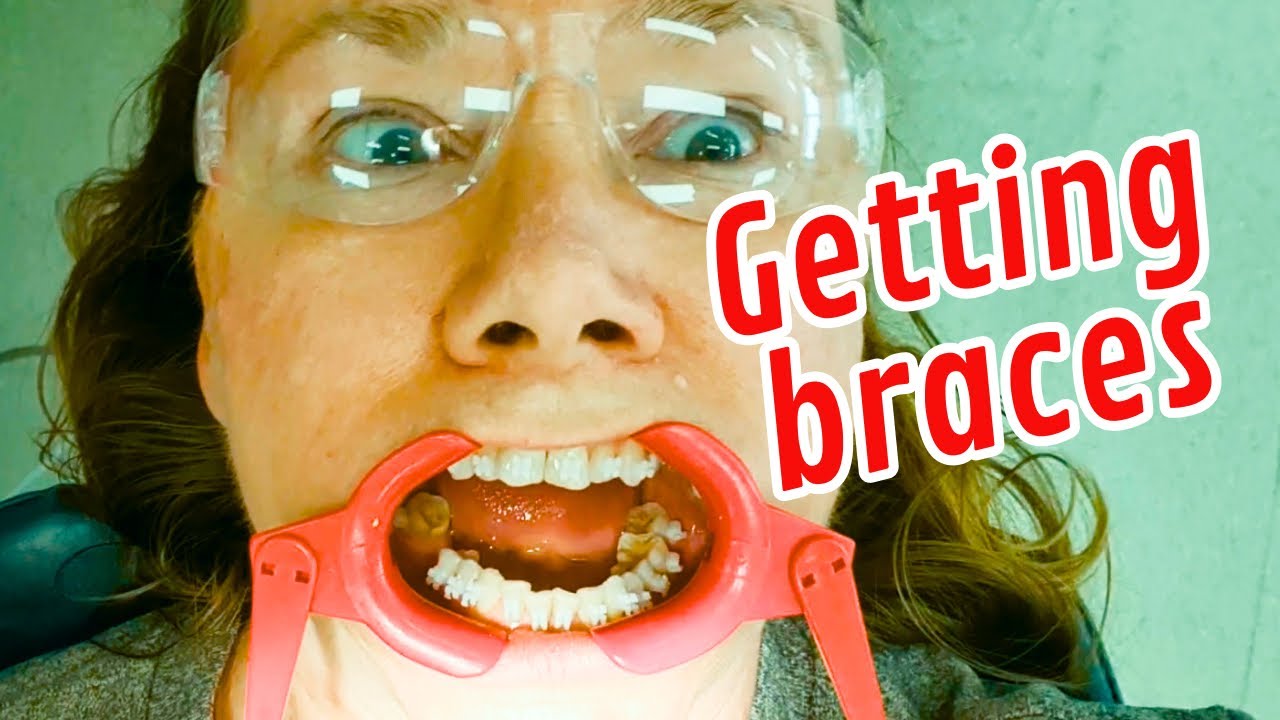 Getting adult braces put on - FULL PROCESS - YouTube