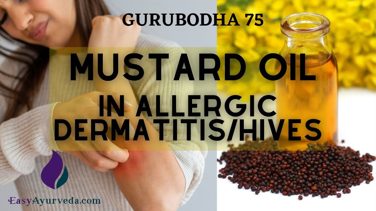 Gurubodha 75: Mustard Oil for allergic hives? Alopecia | Ginger with ...