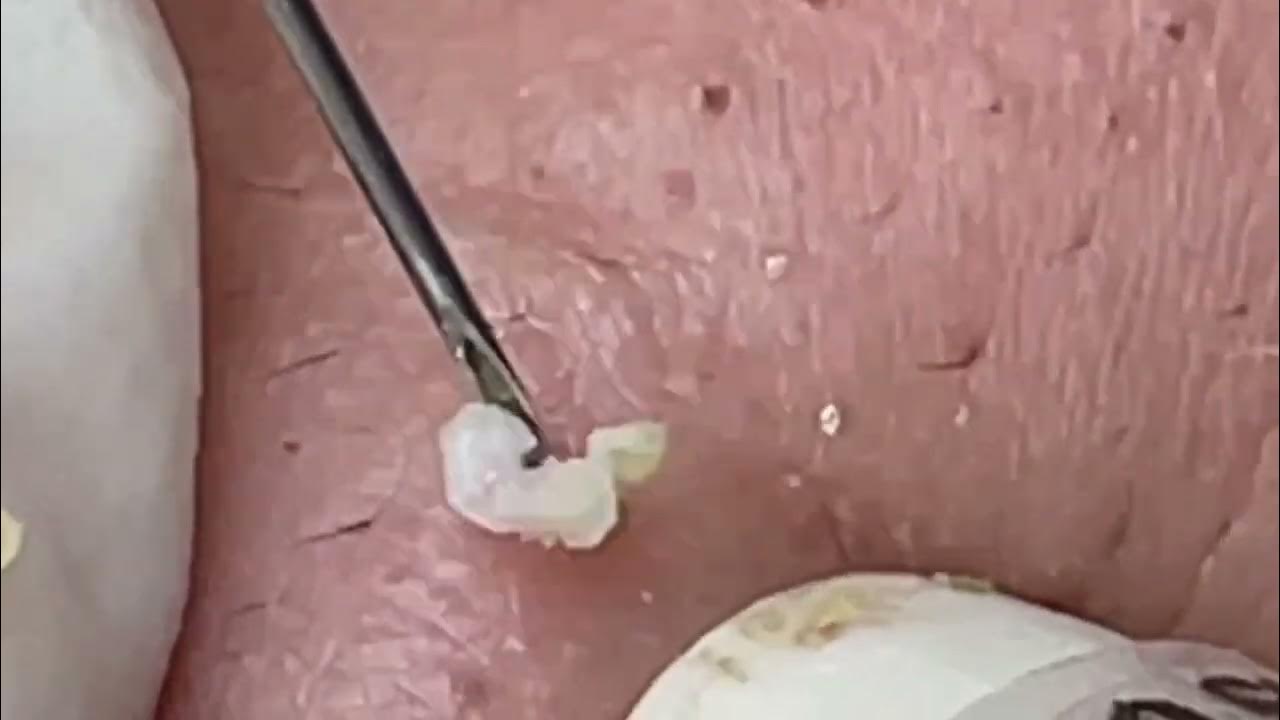 WOW! A GIANT BLACKHEAD EXTRACTION SATISFYING SEBACEOUS FILAMENT REMOVAL #11350 - YouTube