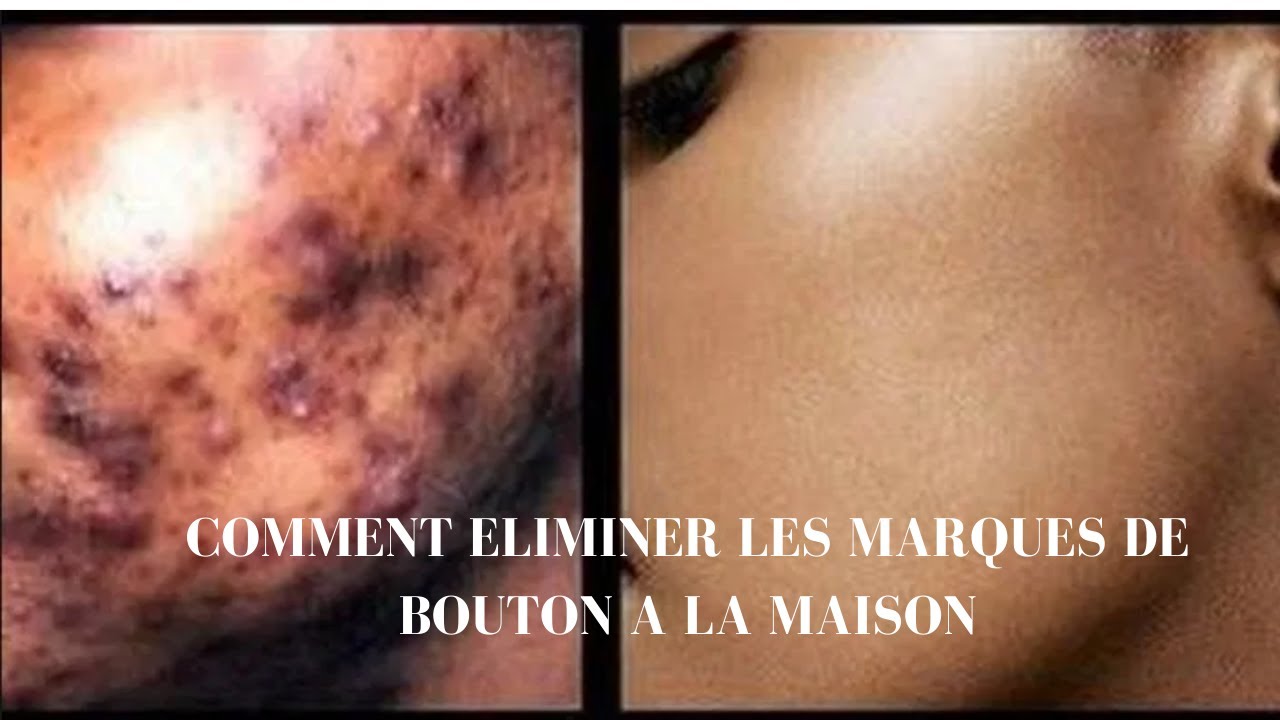 COMMENT SUPPRIMER LES MARQUES LAISSER PAR LES BOUTONS/ ÉLIMINER LES ...