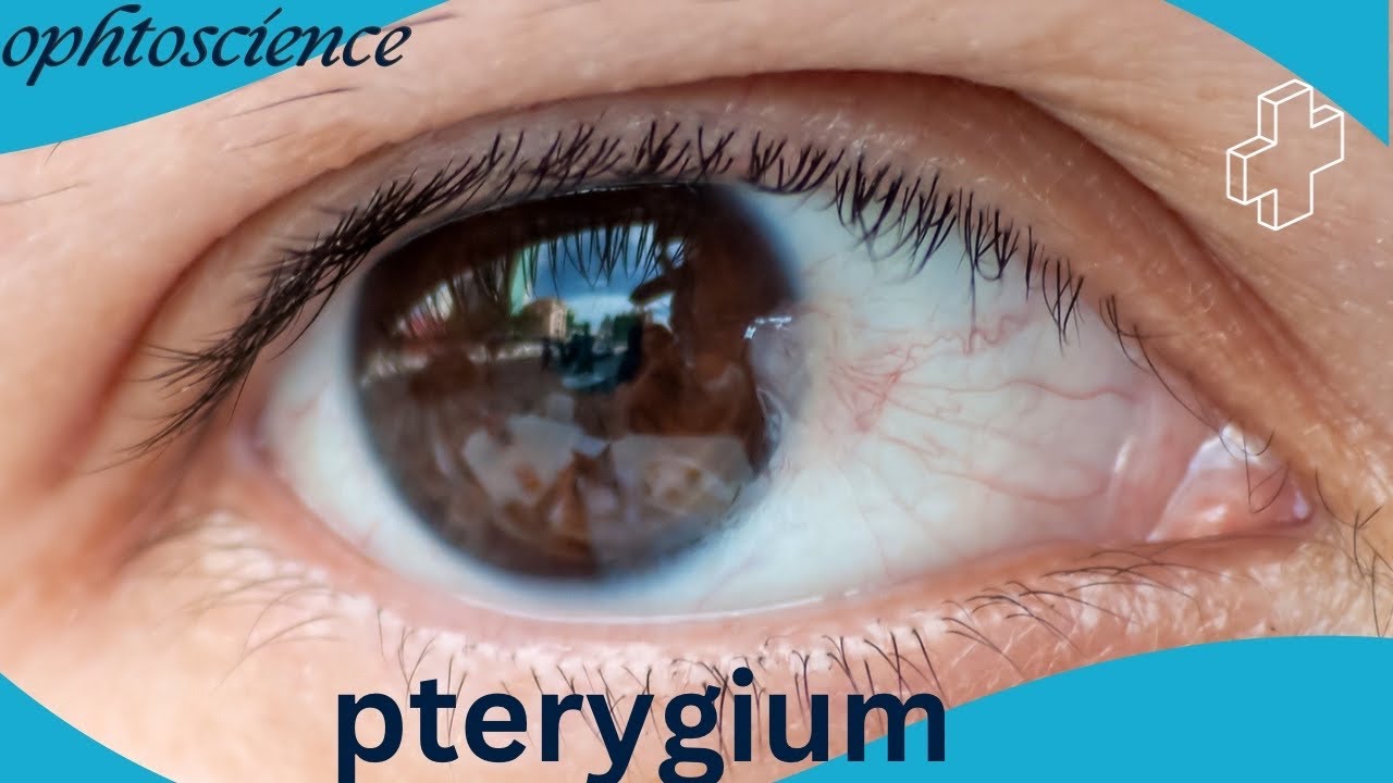 what is Pterygium? Pterygium causes |symptoms |Treatment |prevention ...