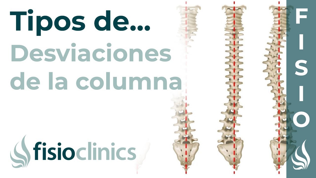 ¿Tipos de desviaciones de la columna? - FisioClinics Palma de Mallorca ...