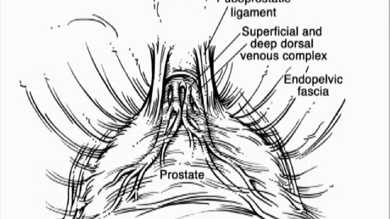 Incision in Endopelvic Fascia & Division of Puboprostatic Ligament ...