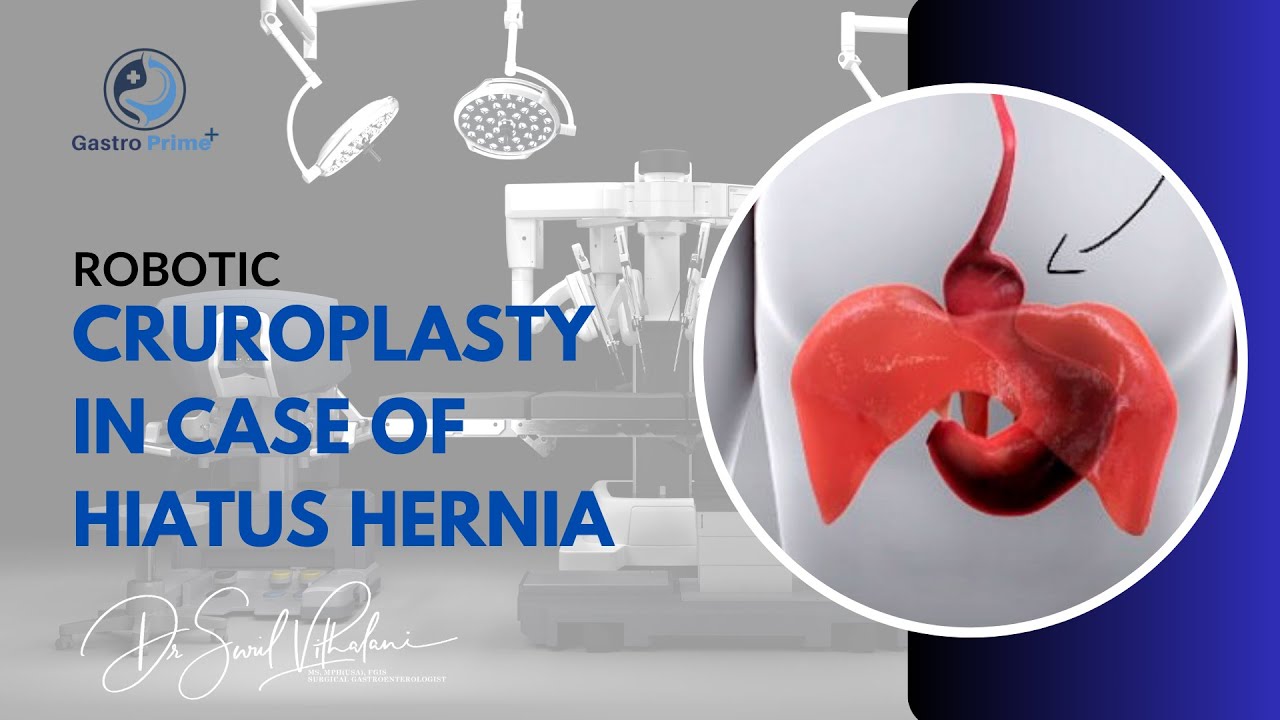 Cruroplasty As A Part Of Robotic Assisted Hiatus Hernia Repair