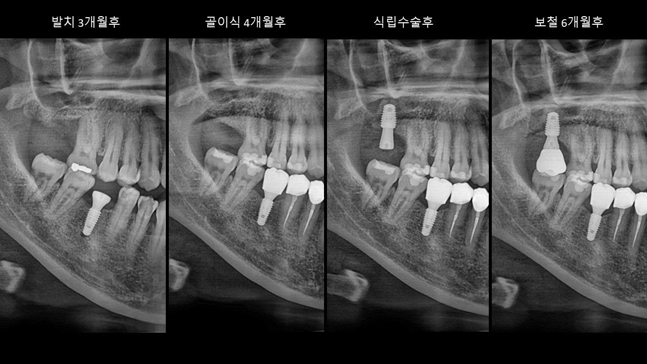 20240526 #17 GBR, BAOSFE, Staged Approach, Implant, The result of ...