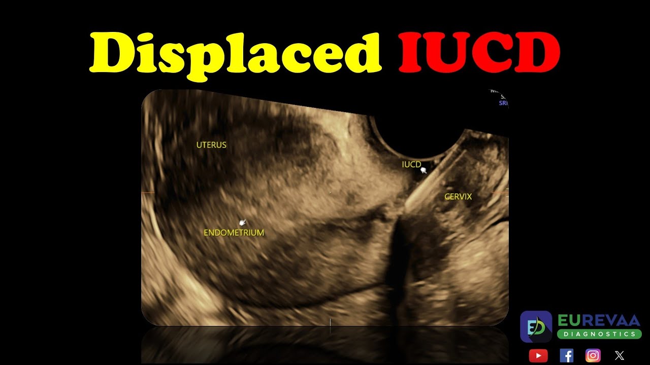 Displaced IUCD (Intrauterine Contraceptive Device) on Ultrasound. - YouTube