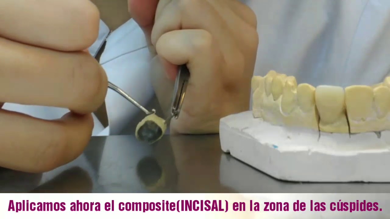 MOLAR EN METAL- COMPOSITE - YouTube