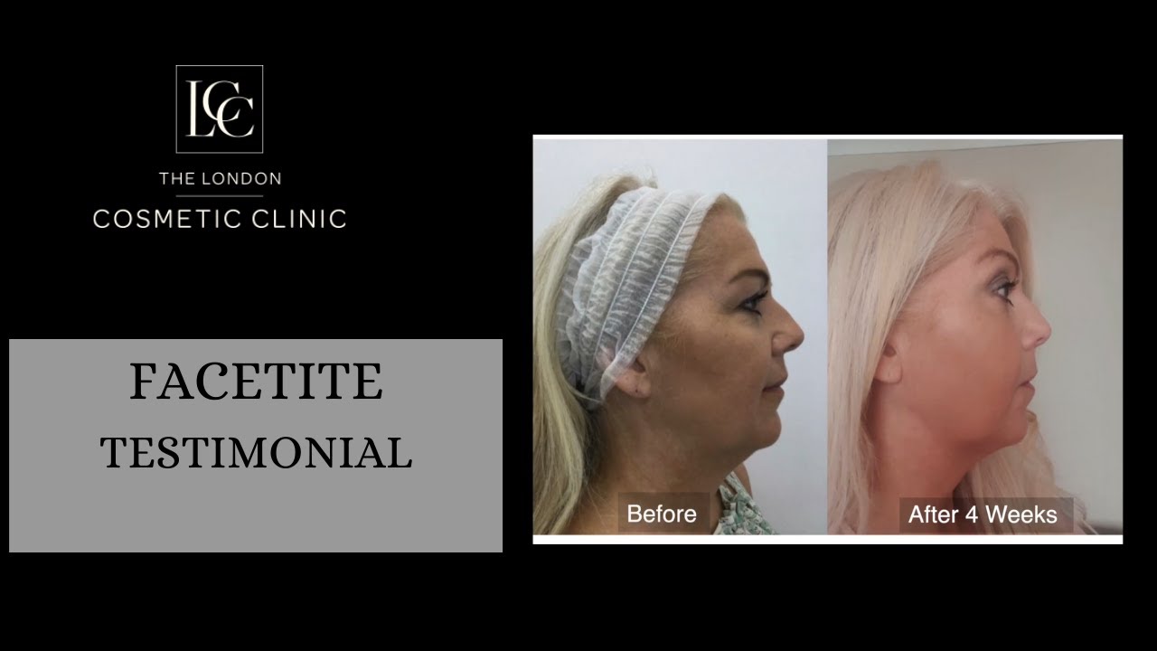 FaceTite Testimonial @ The London Cosmetic Clinic - YouTube