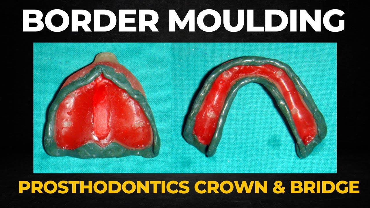 Technique & Procedure of Border Moulding in Complete Denture - YouTube