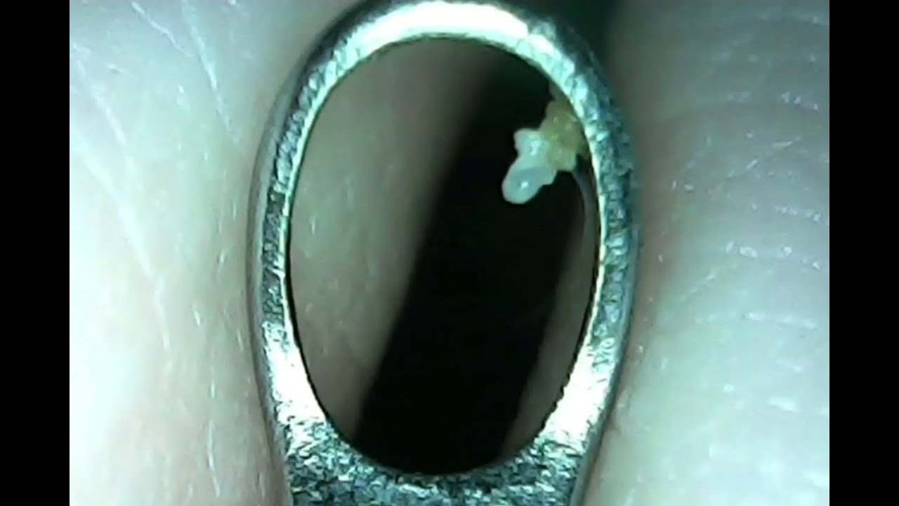 "Zoomed-In Blackhead Popping: Unbelievable Satisfaction Guaranteed Part ...