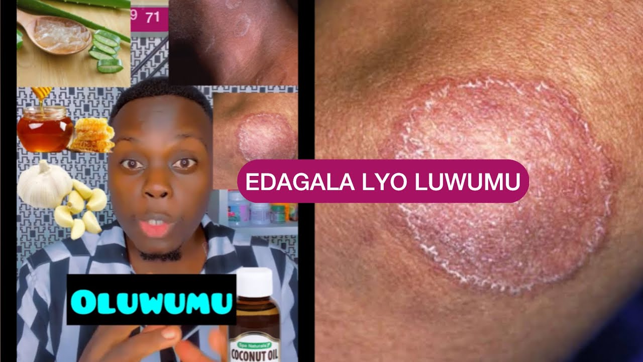 EDAGALA LYO LUWUMU (RINGWORM) - YouTube