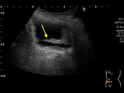 Hematoma from bladder cancer - YouTube