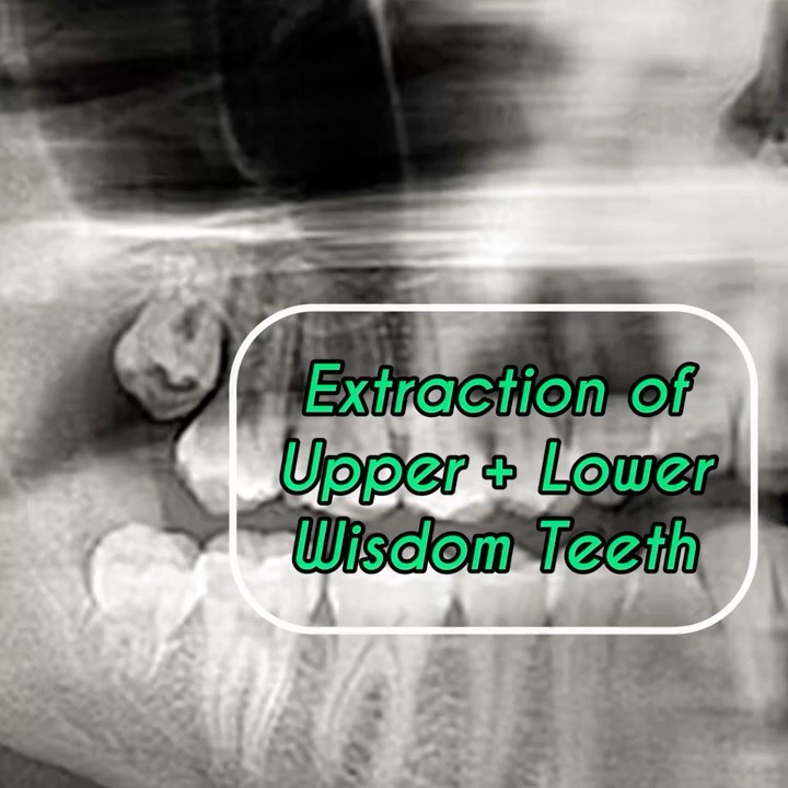Upper and Lower Wisdom Teeth Extractions - YouTube