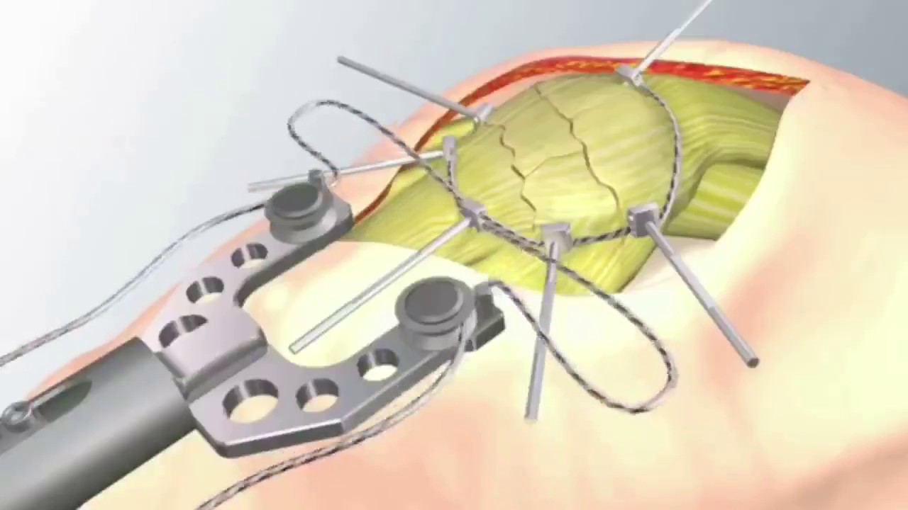 Operación fractura de rotula - YouTube