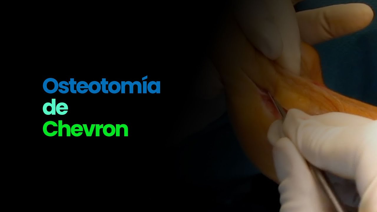 Osteotomia de Chevron - YouTube