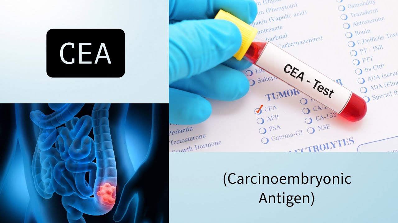 Carcinoembryonic Antigen (CEA) #pathologylectures #pathology - YouTube