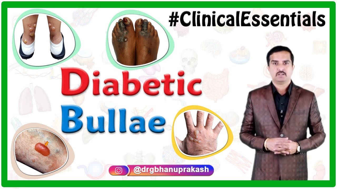 Diabetic bullae (Bullosis Diabeticorum) - Clinical essentials : Dr G ...