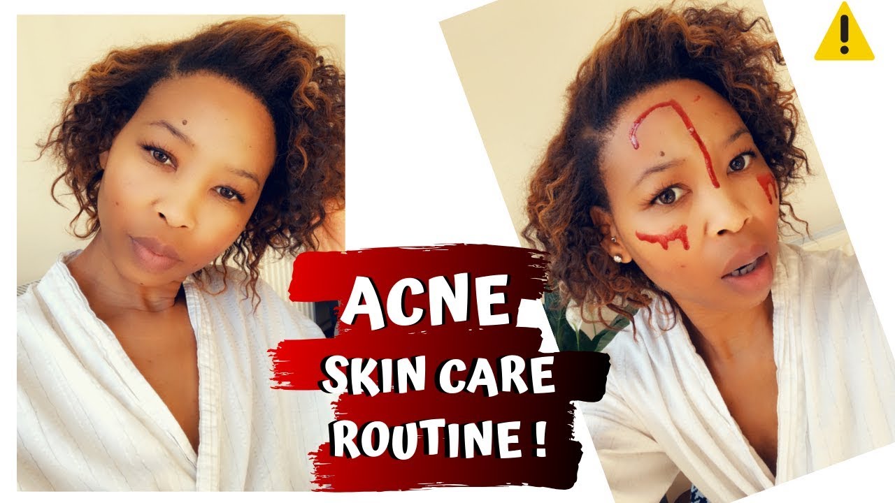 ACNE SKIN CARE ROUTINE | The Ordinary | Acne Treatment | Hormonal Acne ...