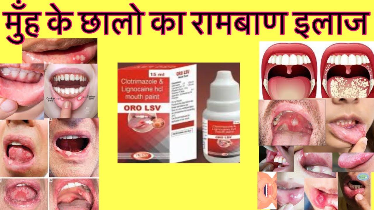 Ora Lsv Gel for mouth ulcer | Treatment of Mouth ulcer | Medical ...