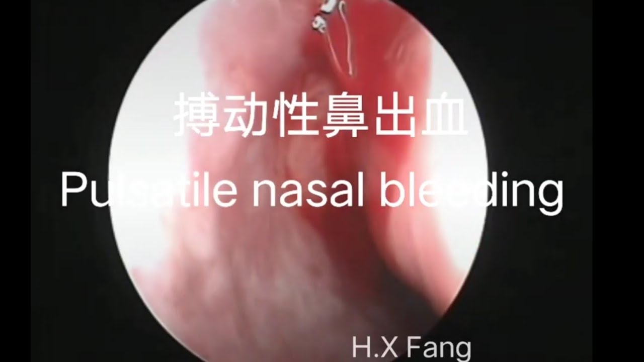 Pulsatile nasal bleeding活动性鼻出血2023-08-15 - YouTube