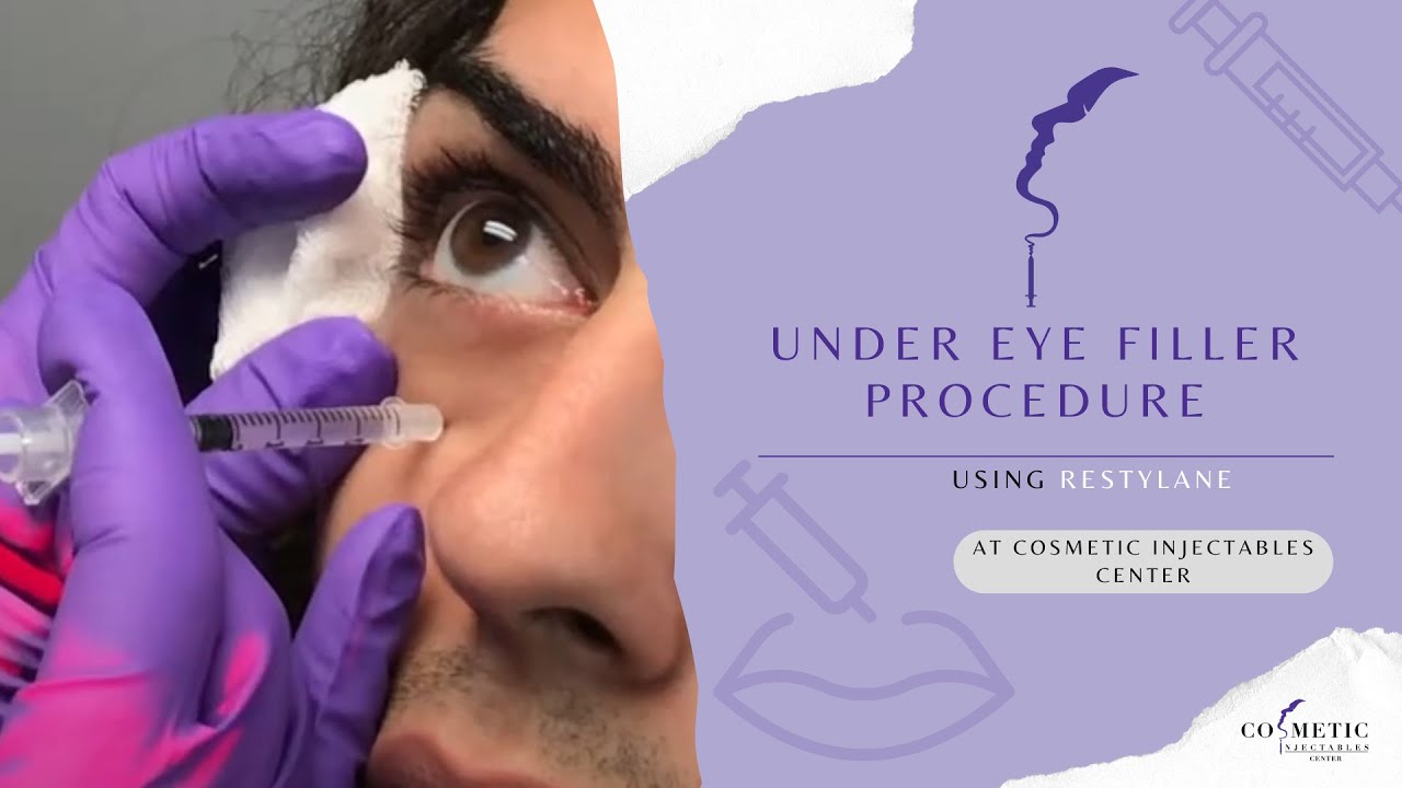 Under Eye Filler Procedure Using Restylane - YouTube