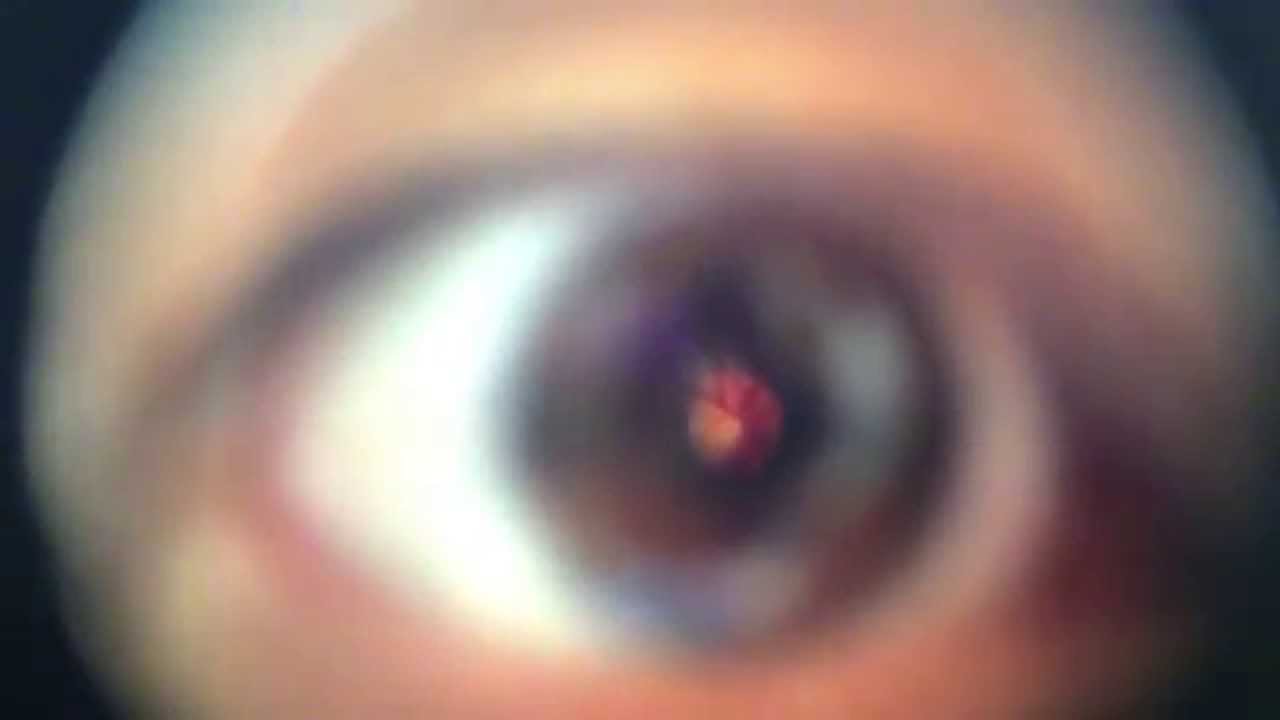 D-EYE with undilated pupil - YouTube