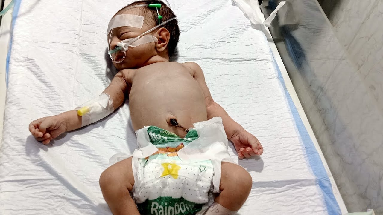 Severe Birth Asphyxia Newborn Baby |NICU Male Nurse Care ...