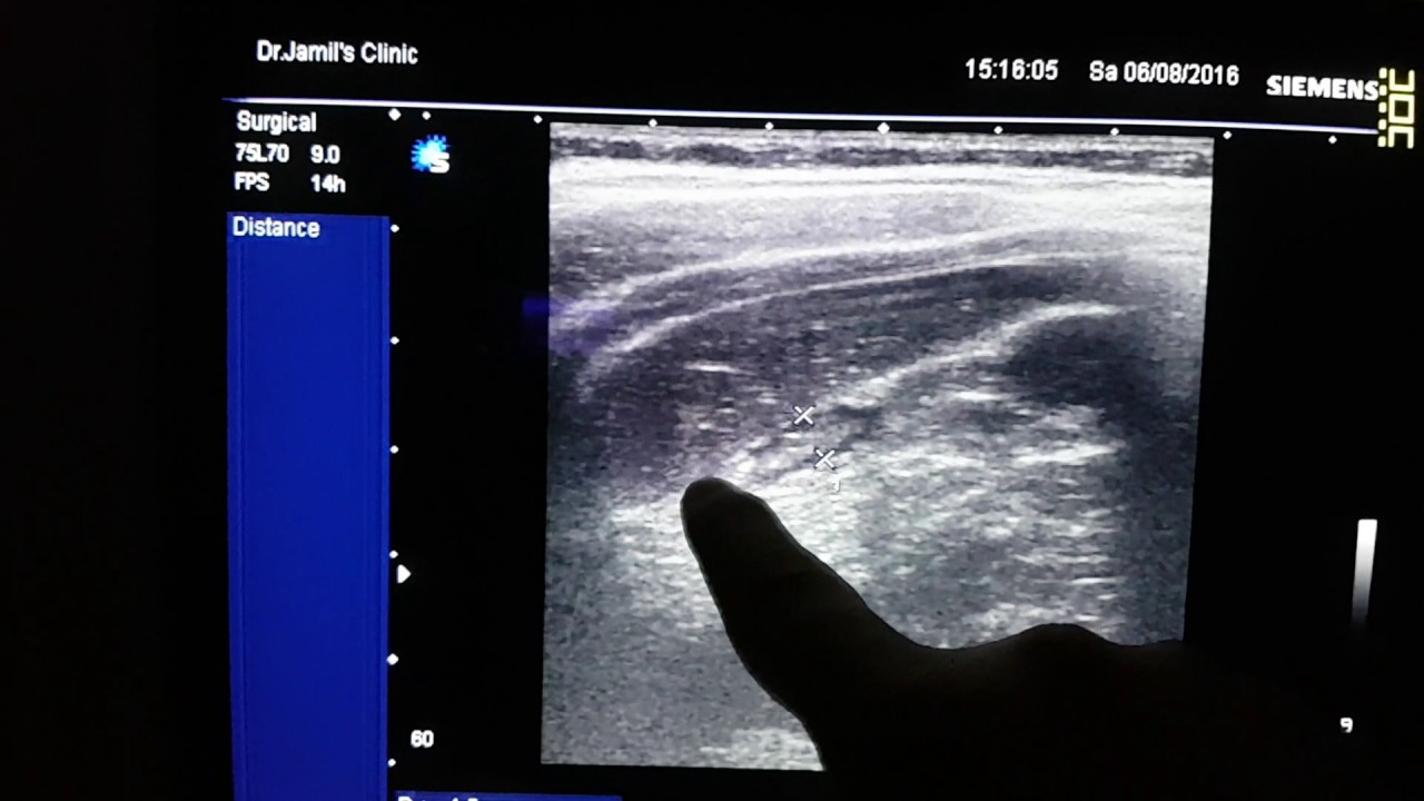 Subhepatic Appendix Sonography - YouTube
