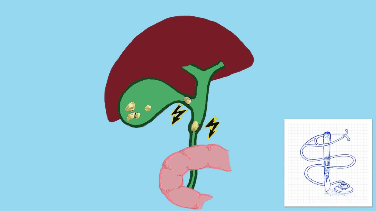 Cholécystite et colique biliaire - YouTube