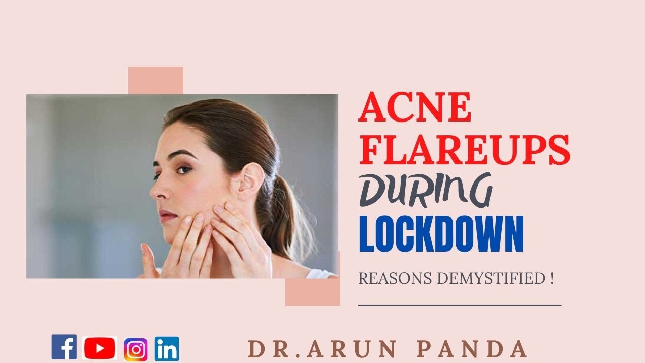 Why people find more Acne flare ups during lockdown- explained in ...