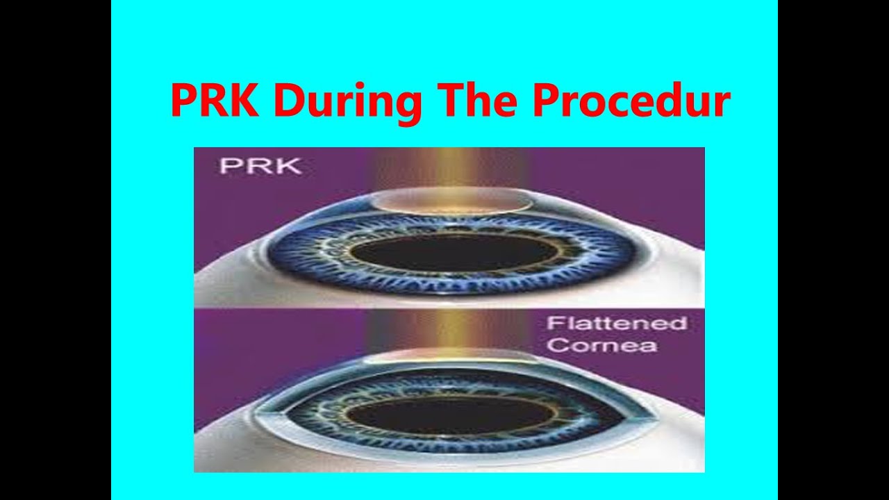 PRK During The Procedur - YouTube