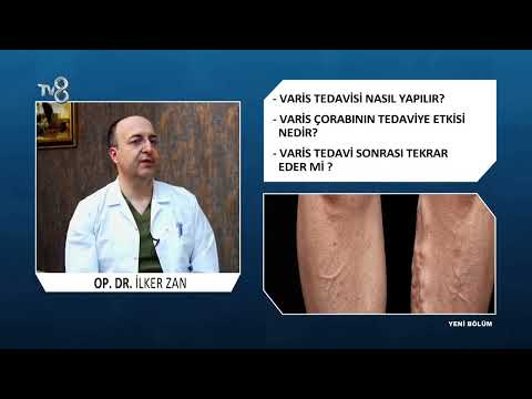 Kılcal Damar Tedavisinde Mükemmellik: Skleroterapi ve Lazerle Nasıl Başarıya Ulaşılır? Antalya Varis