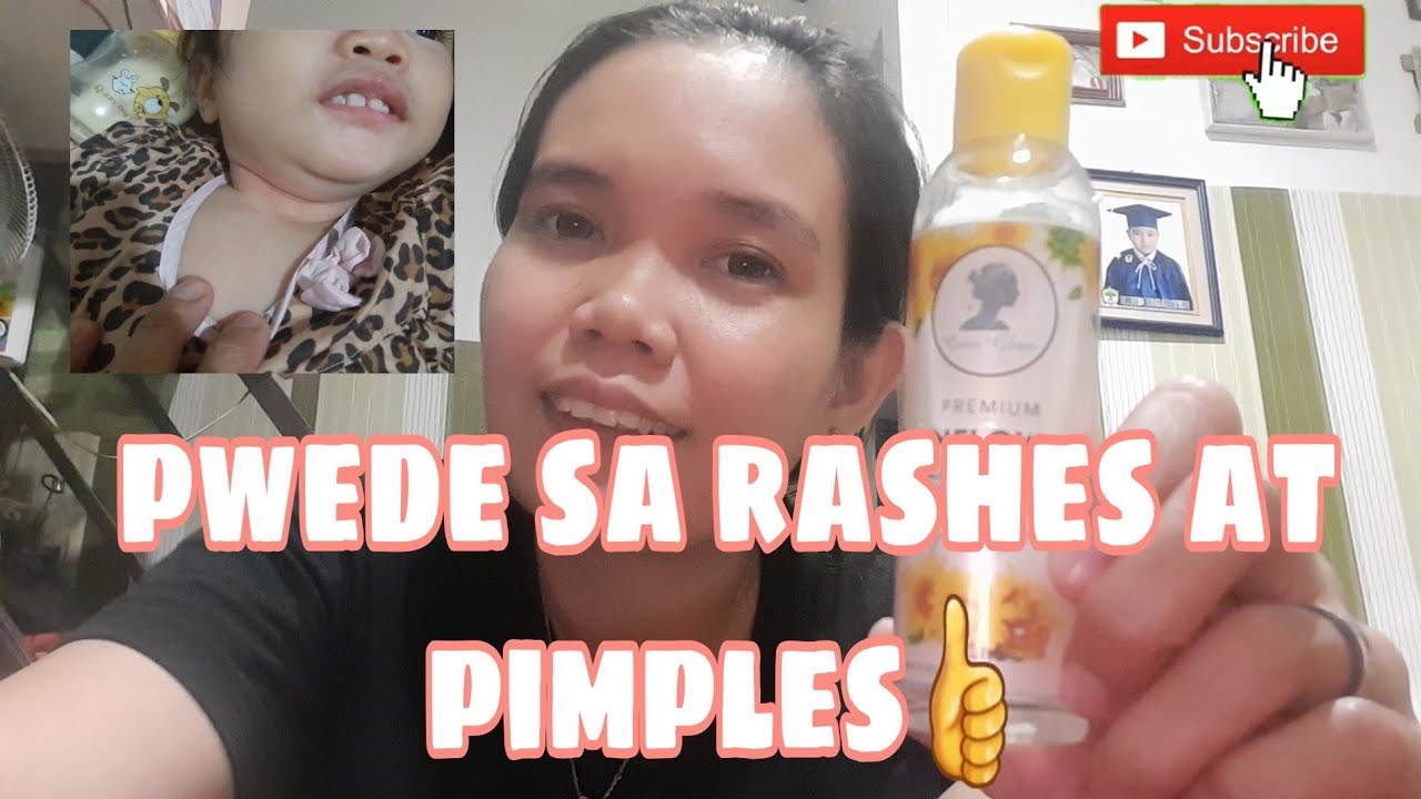 Bagong gamot ko sa rashes ni baby!! | gamot sa bungang araw | gamot sa ...