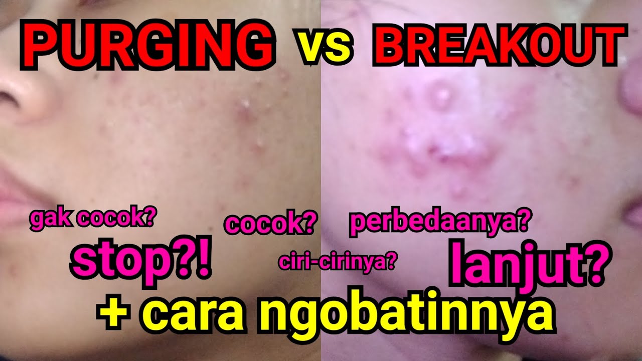 BEDAKAN PURGING VS BREAKOUT, JERAWAT SEMBUH! - YouTube