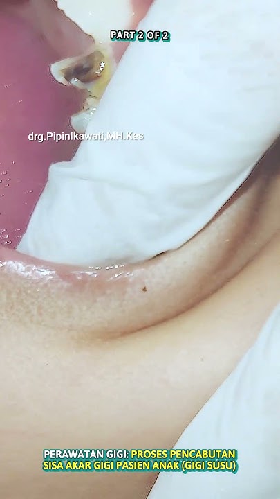 PROSES PENCABUTAN SISA AKAR GIGI PASIEN ANAK (GIGI SUSU) || PART 2 OF 2 - YouTube